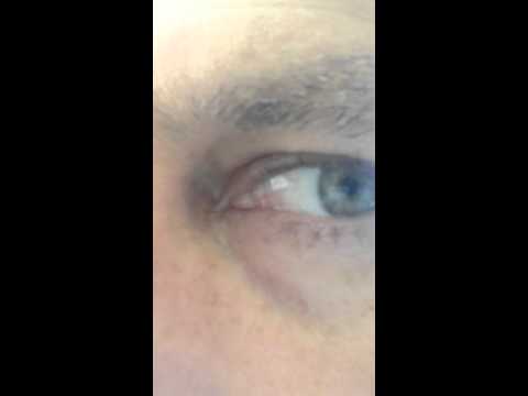 Twitchy eye