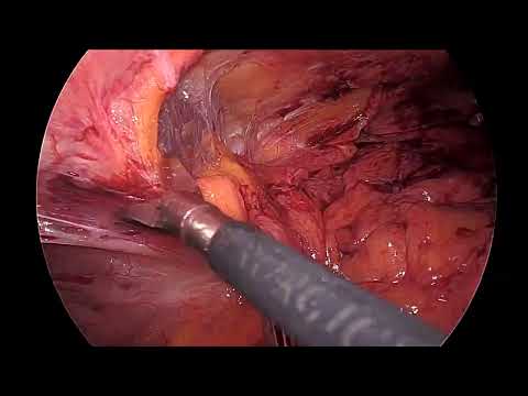 Laparoscopic Roux-en-Y Hepaticojejunostomy for Lower end Benign Biliary Stricture (BBS) 8x Part 2