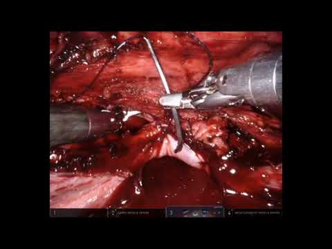 Robotic Hysterectomy with Adhesions