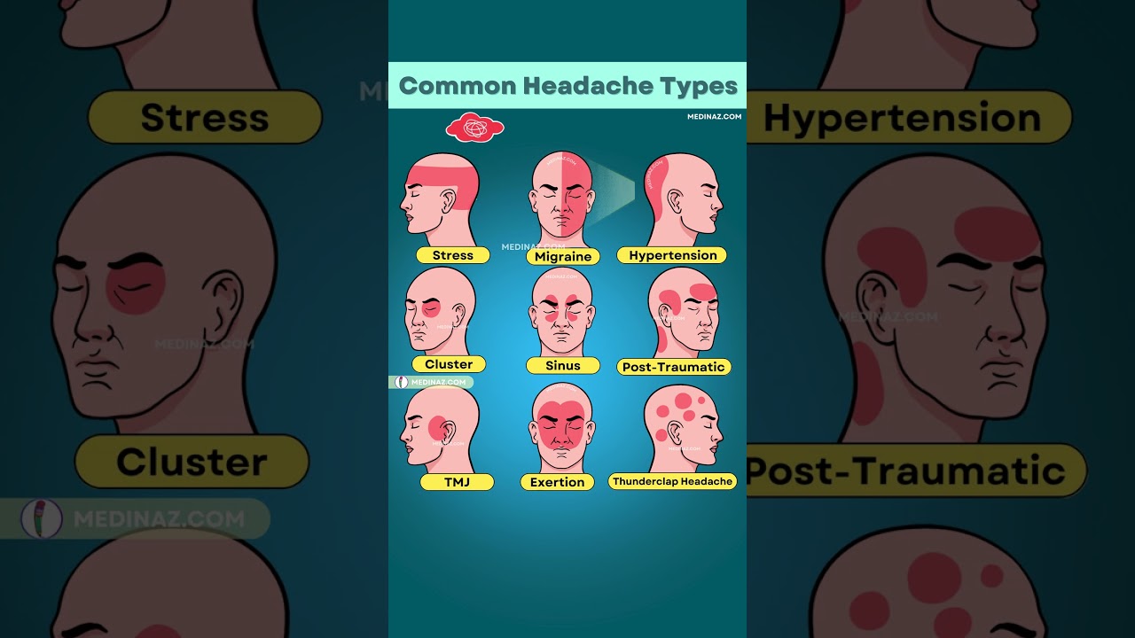 Which Headache Do You Have? 😣 Tension, Migraine, or Something Serious?