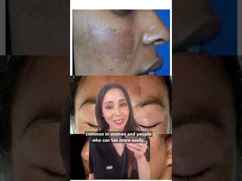 What is Melasma