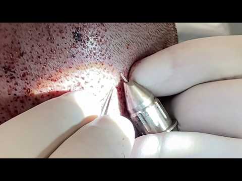 PCID in Action - The best FUE extraction Device for Hair Transplant