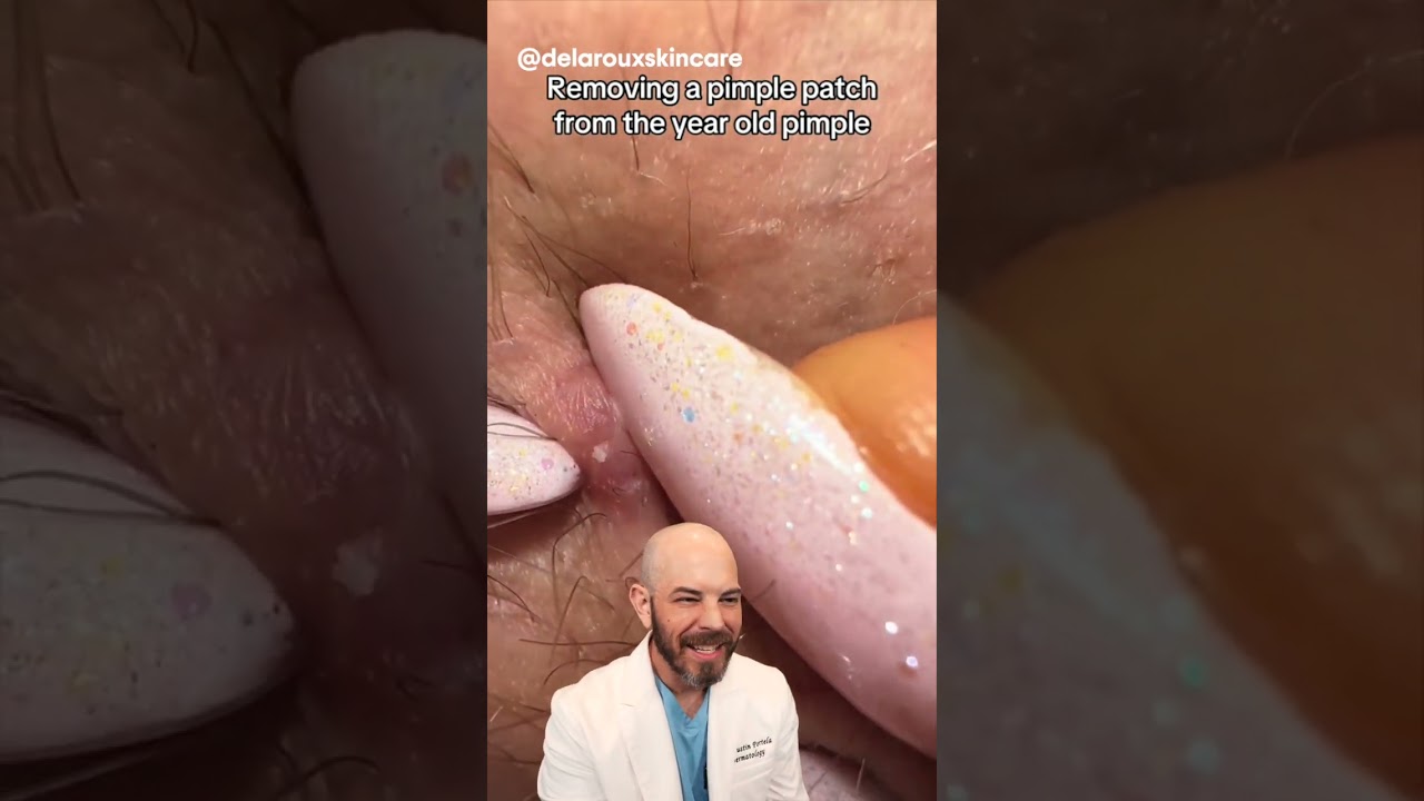 Removing a year old pimple patch👀? (credit:delarouxskincare on TT) #pimple #satisfying #dermatology