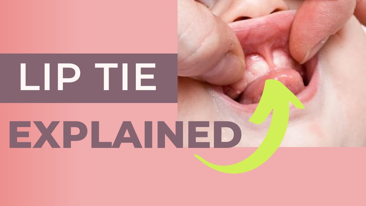 Lip-tie: what you really need to hear from a tongue-tie specialist