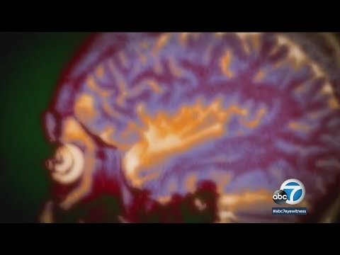 How to recognize the early signs of Alzheimer's disease | ABC7