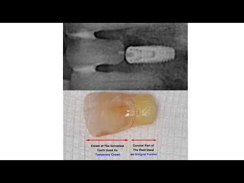 Dr.Aghyad : Natural tooth as a gingival former for immediate dental implant