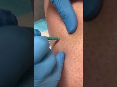 Derm performs skin cancer testing! #skincancer #mole #dermreacts