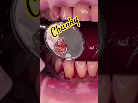 Dental calculus removal #dental #teeth #calculus