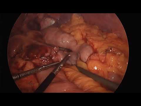 Video: Use of ICG dye during Roux-en-Y Gastric Bypass