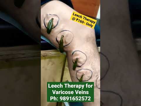 #Leech #Therapy for #Varicoseveins /Ph: 9891652572 #viral #jonk/ Dr. Aamir Atique Hijama / Leech