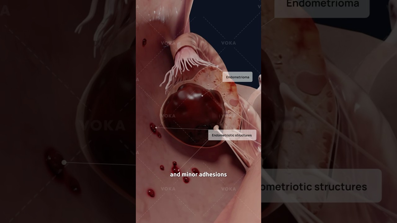 How does stage 2 endometriosis affect the ovaries and pelvic peritoneum? 3D visualization