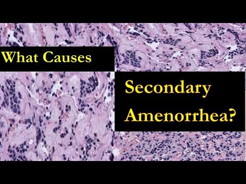 What Causes Secondary Amenorrhea | Reasons for Missed Periods but not Pregnancy