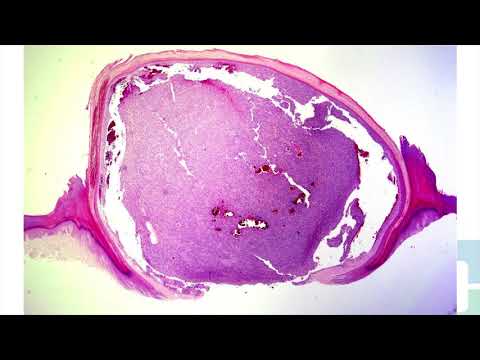 Update in Molecular Diagnostics for Cutaneous Malignancies