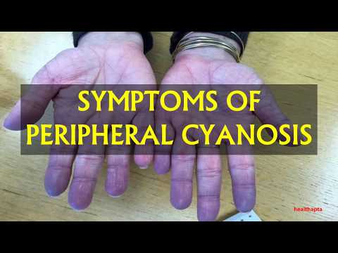 SYMPTOMS OF PERIPHERAL CYANOSIS