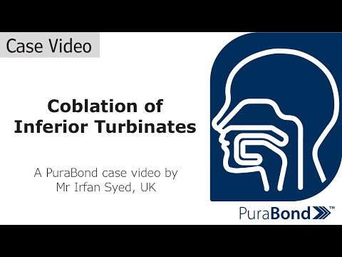 Case Video: Coblation of Inferior Turbinates