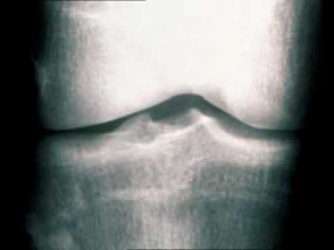 Articulación Diana | Hemofilia Rehab