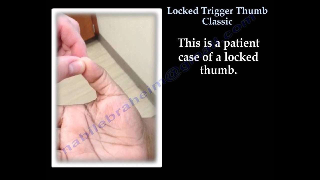 locked Trigger Thumb Classic - Everything You Need To Know - Dr. Nabil Ebraheim