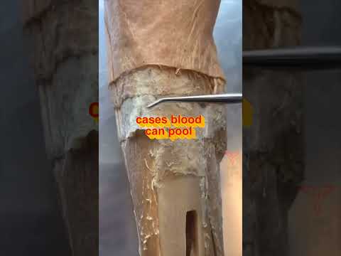 Can Travis Kelce play with a BONE BRUISE? Injury UPDATE!
