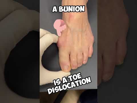 What is a Bunion?