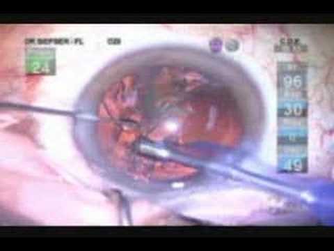 Dr. Steven Siepser performs Crystalens vision surgery