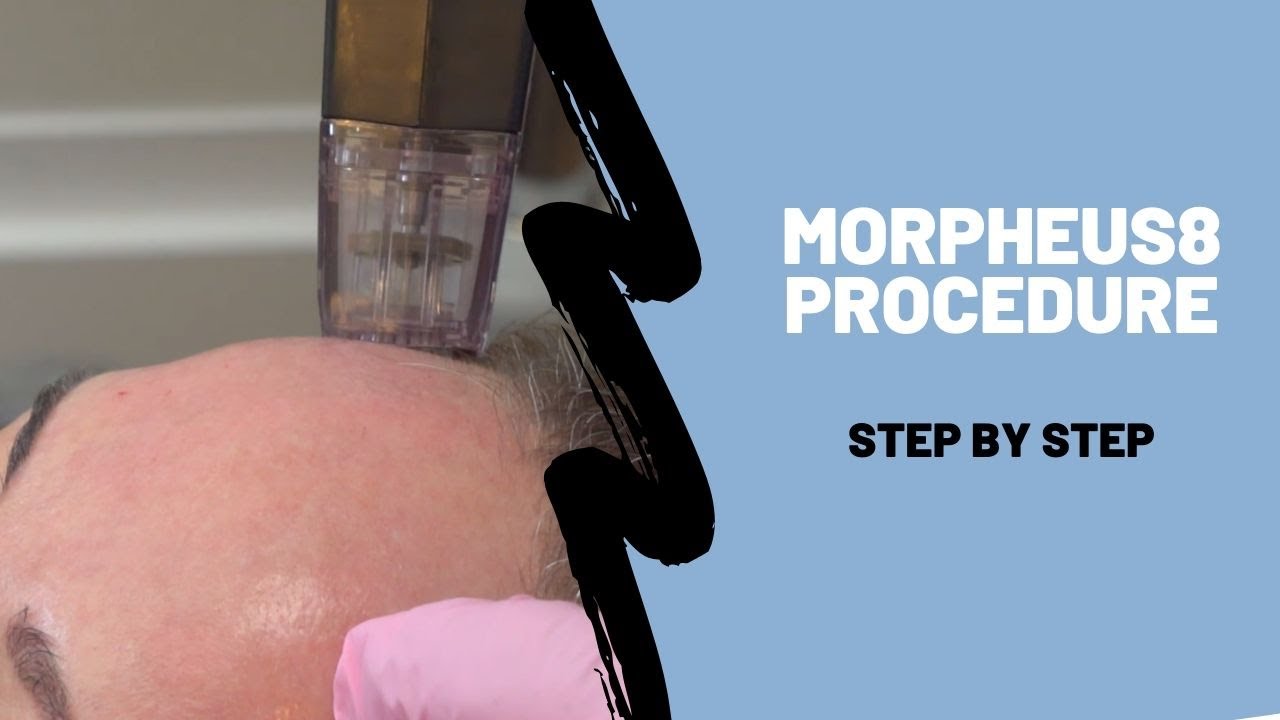 Morpheus8 - Step by Step Procedure Breakdown