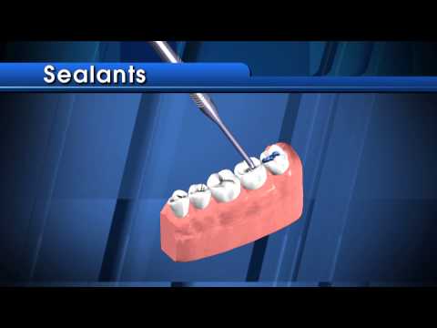Adult Sealants