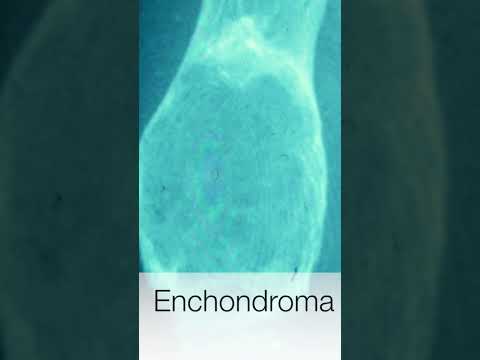 Enchondroma - Pathology #shorts