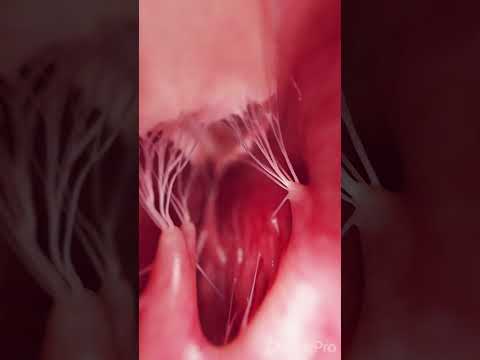 Dive Into the Heart: Discover the Chordae Tendineae