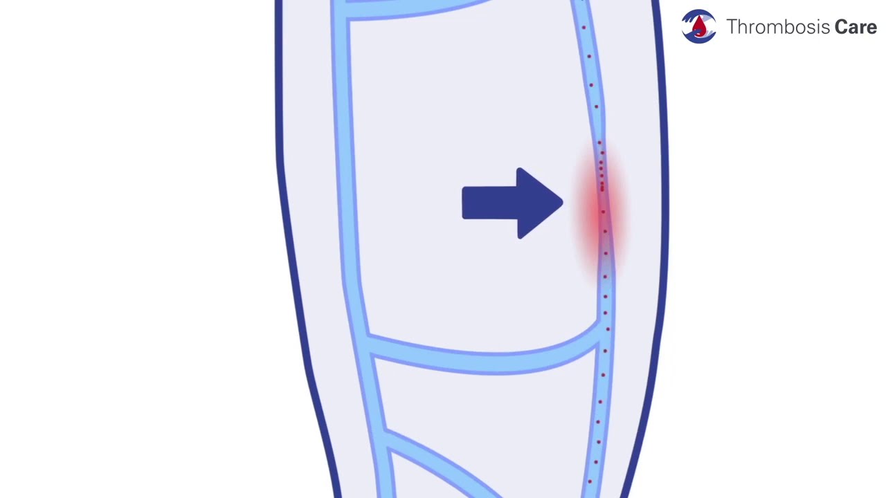 Oppervlakkige veneuze trombose