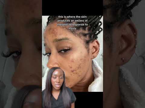 Types of Hyperpigmentation