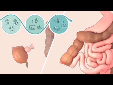 Ileocolic resection for Crohn's disease | Patient Education | TVASurg