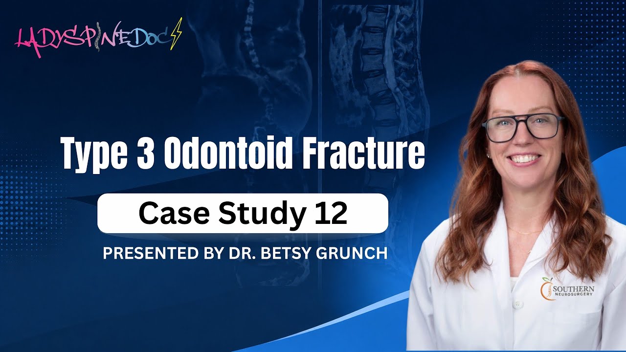 Case study 12 | Type 3 Odontoid Fracture, treated with traction and fusion | Presented by Dr. Grunch