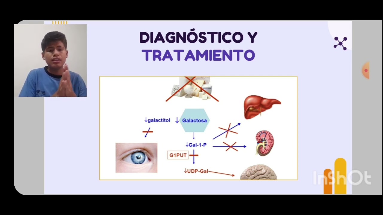 Alteración del metabolismo de la galactosa