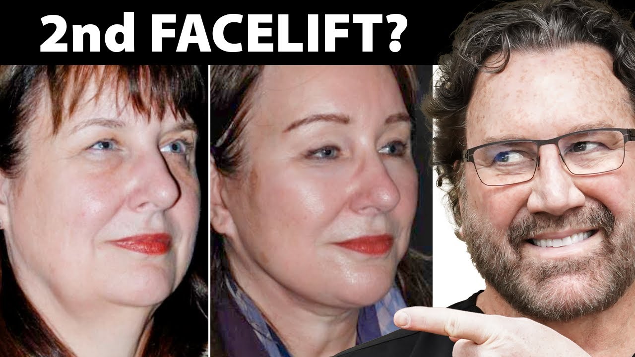 Revising a Facelift | Secondary Facelifts, Wait Time, Risks & Complications | Surgeon Reveals