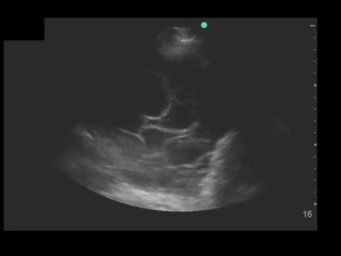 Septated Pleural Effusion