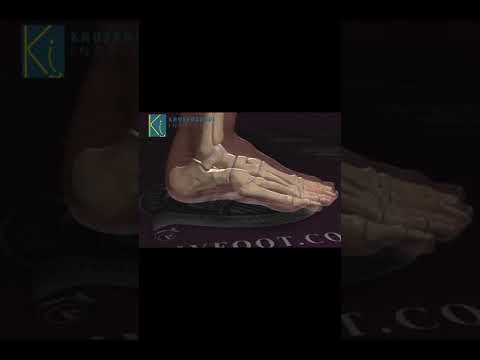 How to repair flat feet?