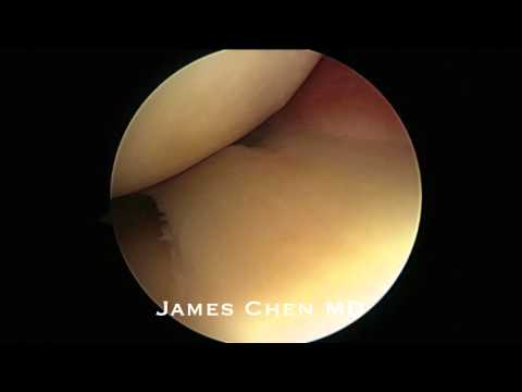 Diagnostic Arthroscopy of the Knee