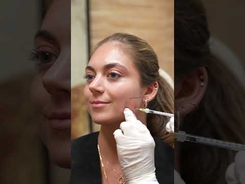 Masseter Botox