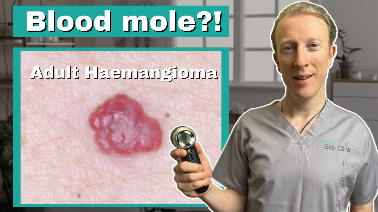 Haemangioma, Adult Onset: Doctor Explains Why That's Not A Mole!