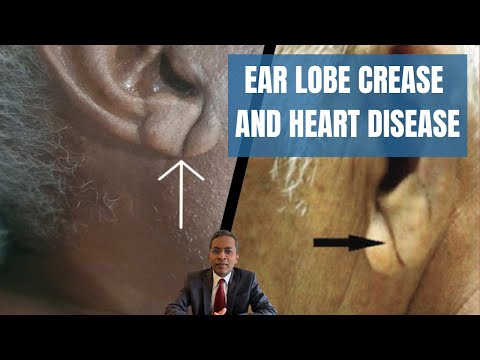 Ear lobe crease as a marker of heart disease - Frank's sign