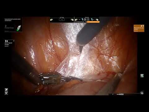 Horseshoe Kidney Heminephrectomy | Michael Palese, M.D. | Mount Sinai, New York