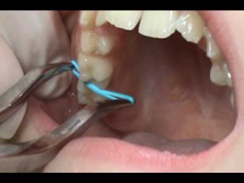 What are spacers? Dr. Powell's office explains!
