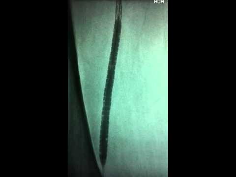 Periferik arter hastalığı ersan tatlı