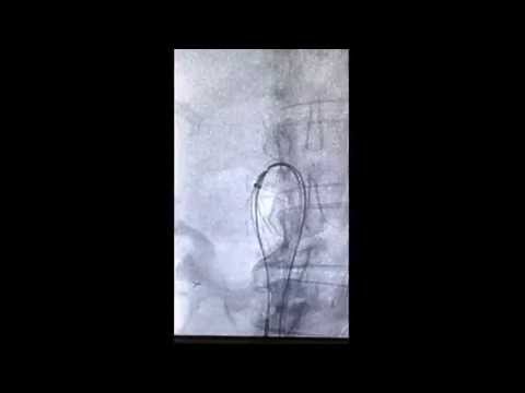 Innovative IVC Filter Retrieval - University of Chicago