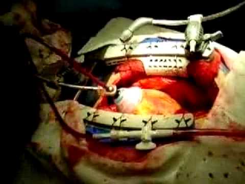 Apical positioning in OPCAB