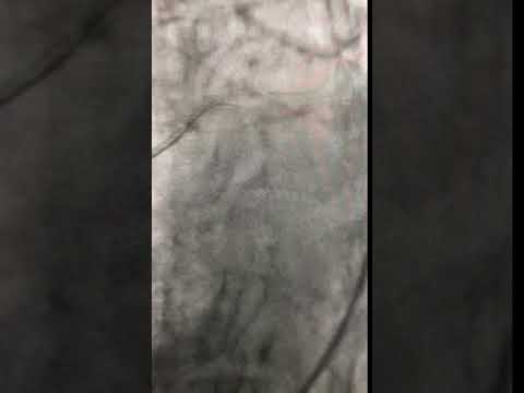 Cardiac Catheterization