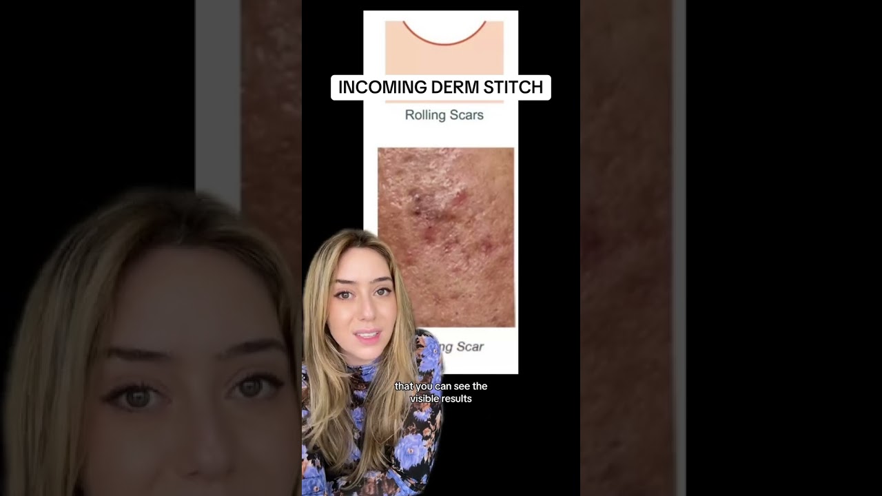 Treating Acne Scars Part 3 #shorts