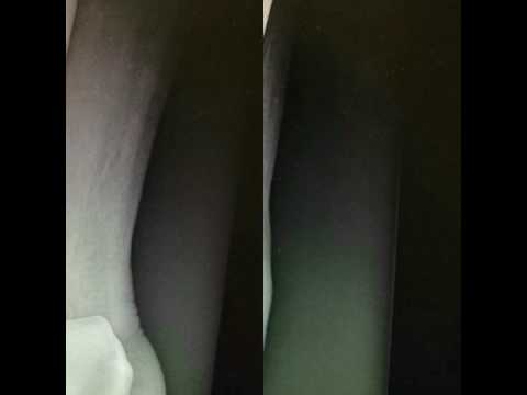 Maisonneuve fracture!