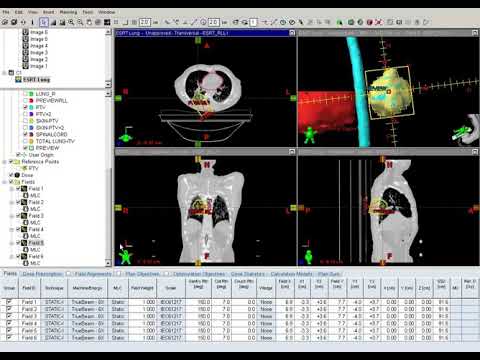 4 Beam Arrangement for Lung SBRT