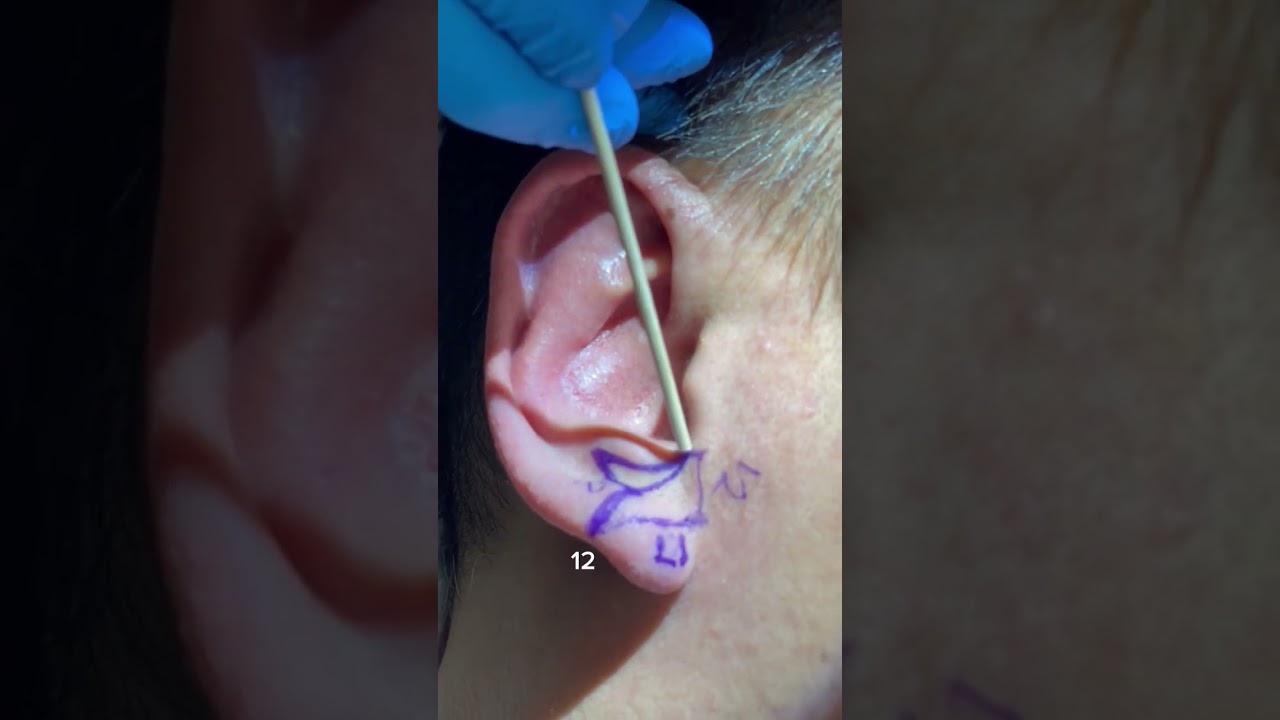 EAR REDUCTION SURGERY (OTOPLASTY) - DR. TANVEER JANJUA - NEW JERSEY